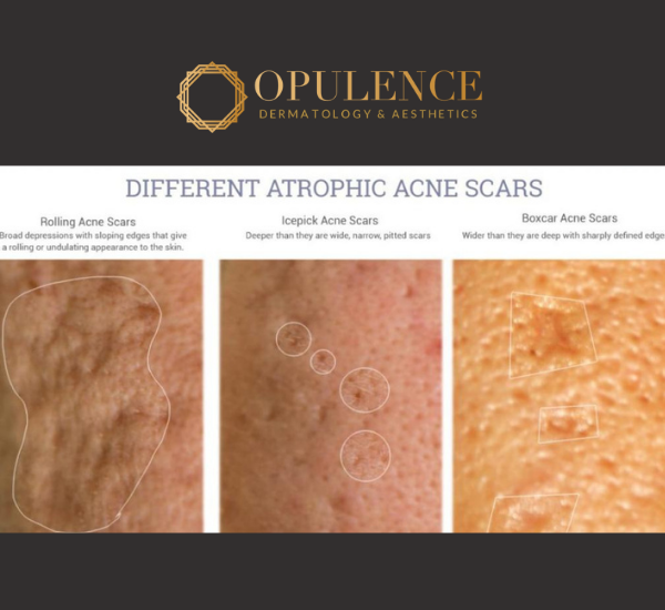 ACNE SCARS. TYPES. TREATMENT - Opulence Dermatologist & Aesthetics