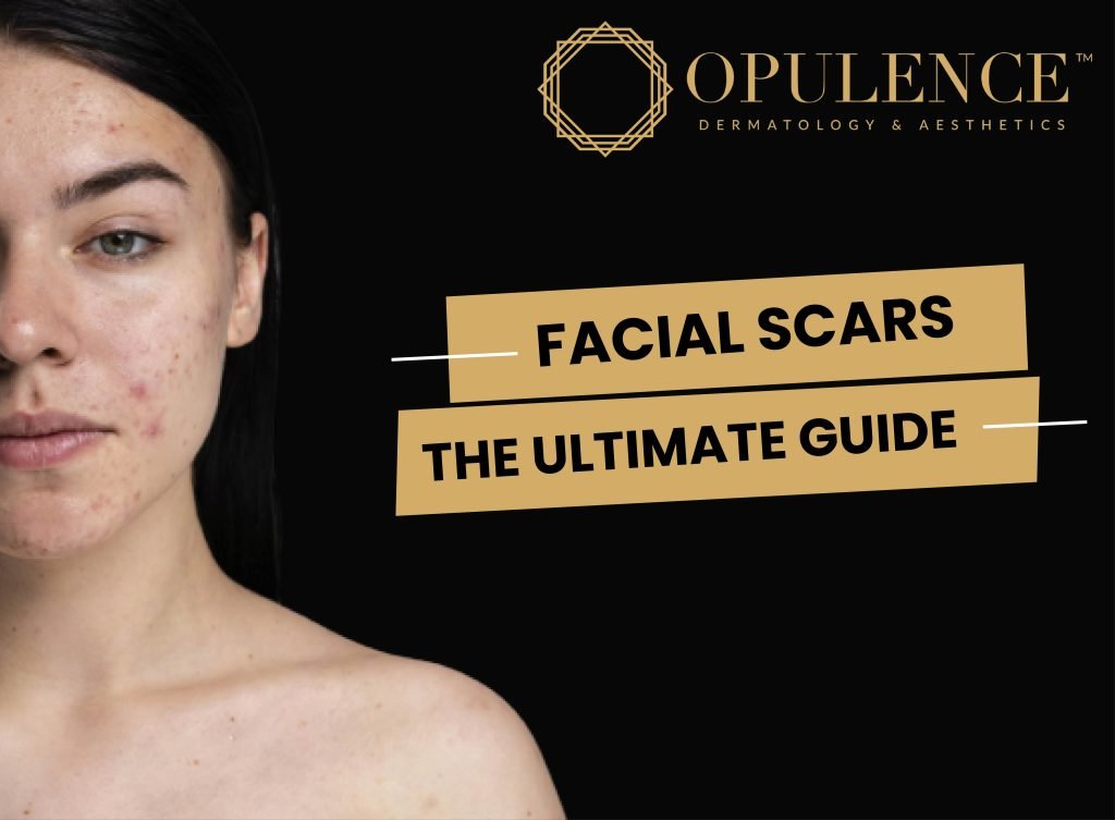 FACIAL SCARS : THE ULTIMATE GUIDE - Opulence Dermatologist & Aesthetics